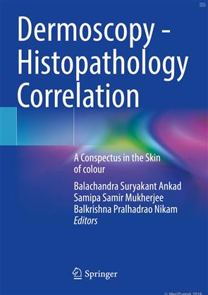 Dermoscopy Histopathology Correlation A Conspectus In The Skin Of ...