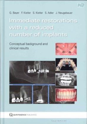 Immediate Restorations With A Reduced Number Of Implants : Conceptual ...